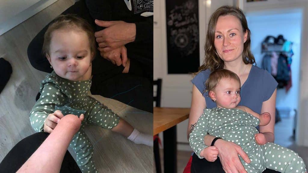 Toddler With One Arm Meets Adult With Same Condition